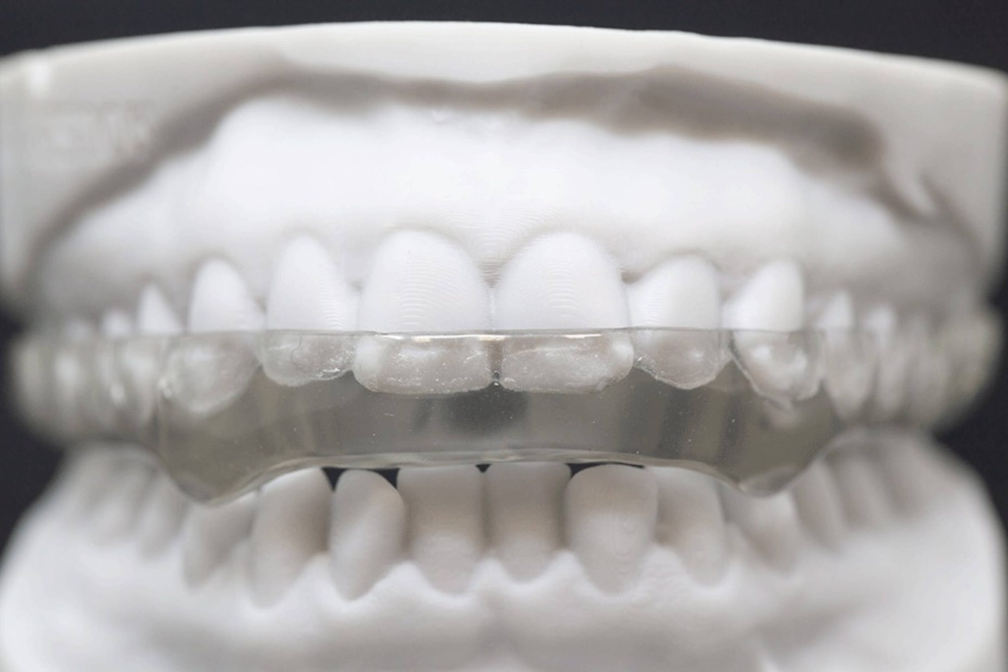 Occlusal Plates - Bruxism Protection in Rosemère